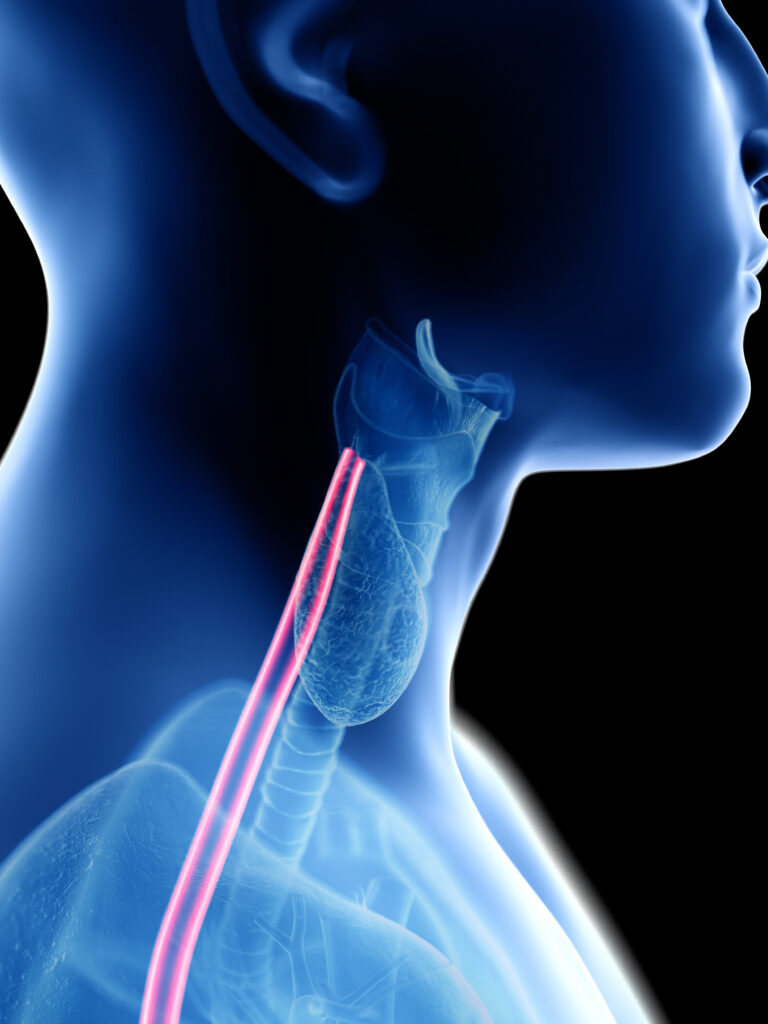Difficulty Swallowing EoE - EBGCR: Encore Borland Groover Clinical Research