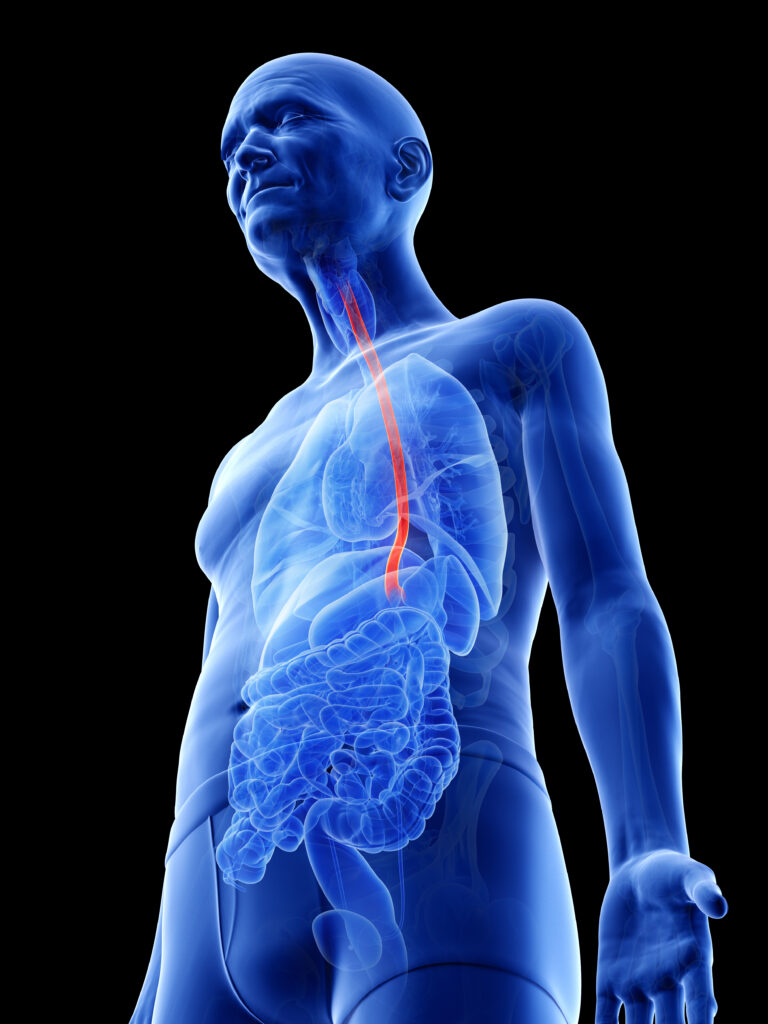 NERD Non-Erosive Gastroesophageal Reflux Disease - EBGCR: Encore ...